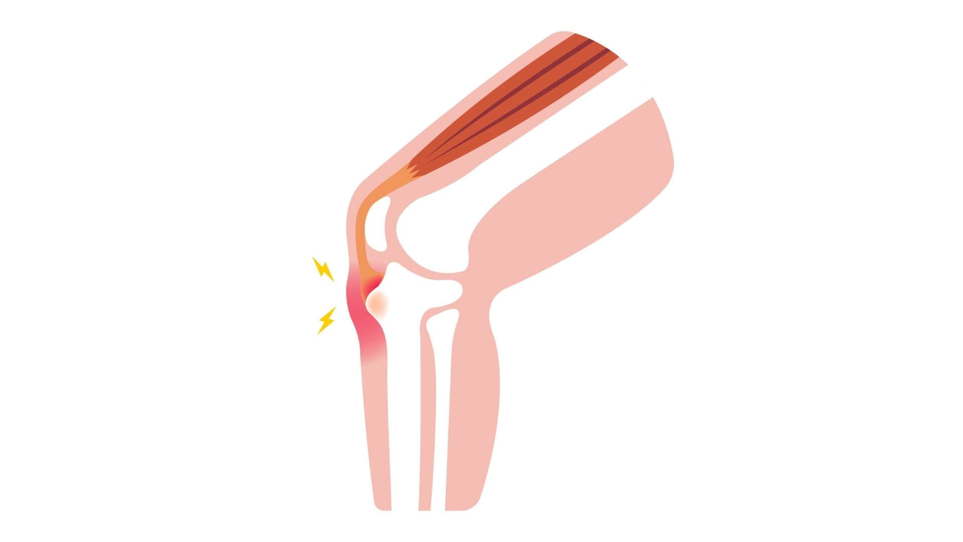 Osgood Schlatters Disease South Cambridge Physio